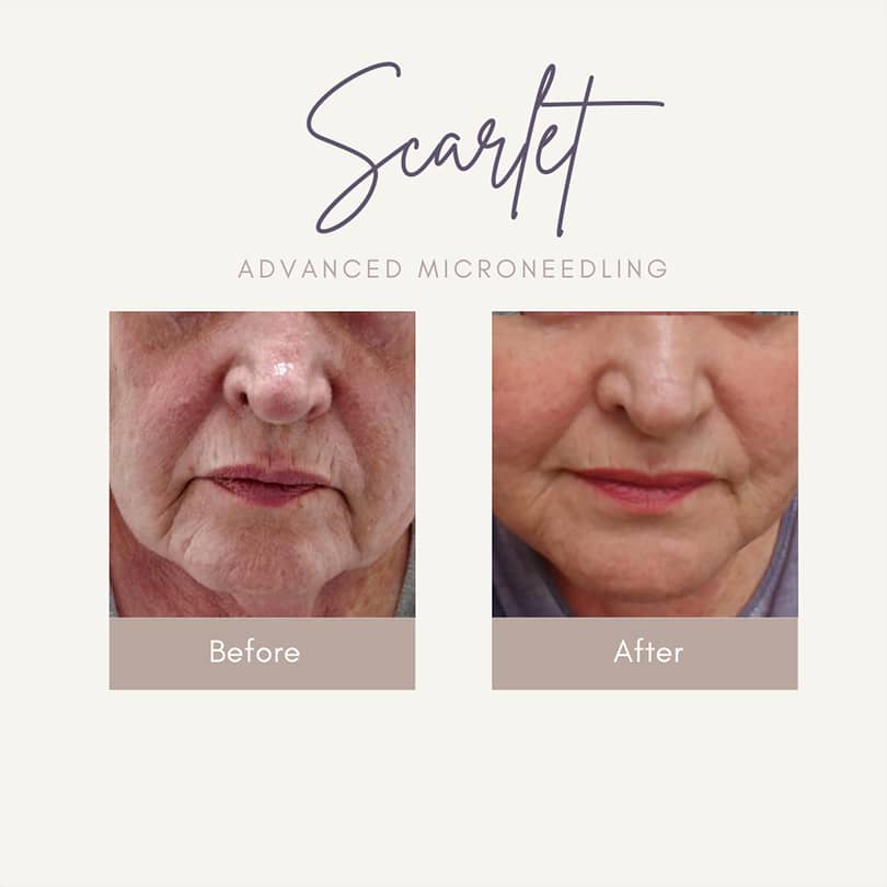 Scarlet RF microneedling