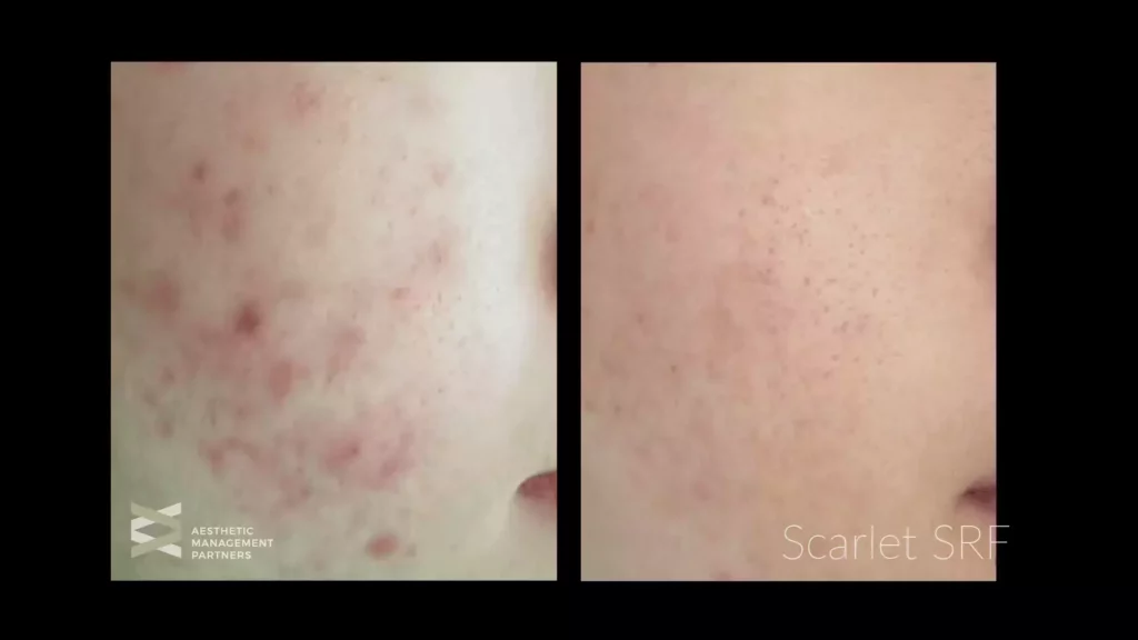 Radiofrequency microneedling | Pure Body Health
